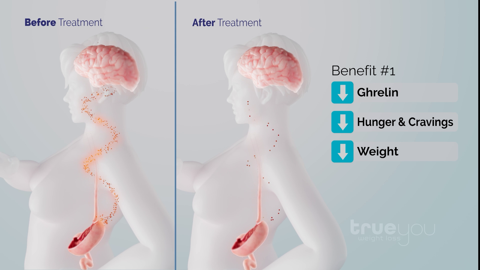 ESG-MAX: Treatment Animation For Patient - UThink Med Visuals